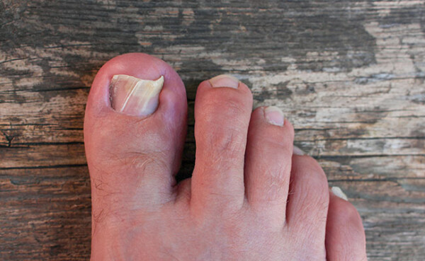 Consejos para prevenir las uñas encarnadas | Aprende Institute